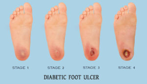 9 Diabetic Foot Ulcer Pictures- Detailed Image Explanation