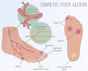 9 Diabetic Foot Ulcer Pictures- Detailed Image Explanation